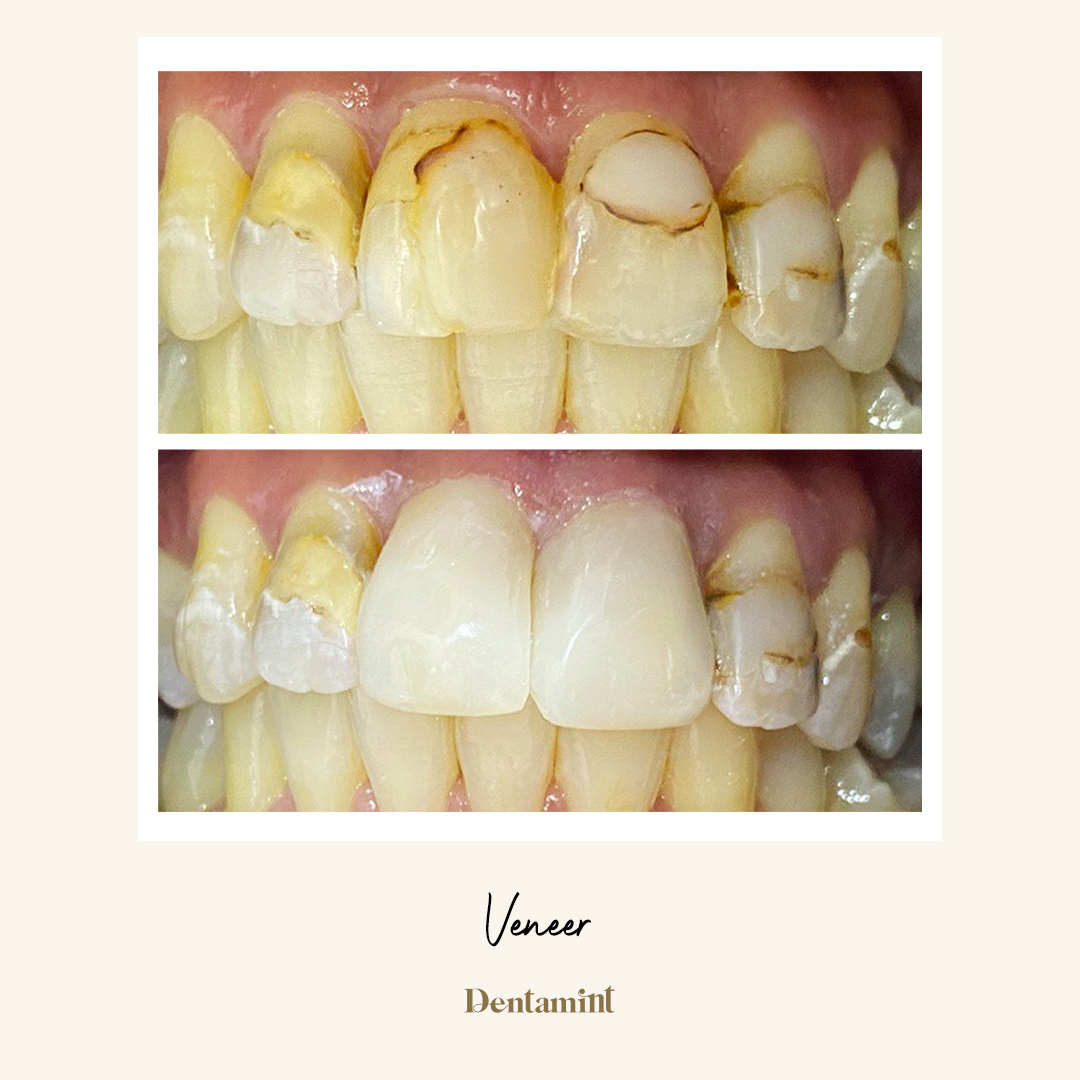 Veneer - Klinik Pergigian Dentamint Bandar Saujana Putra