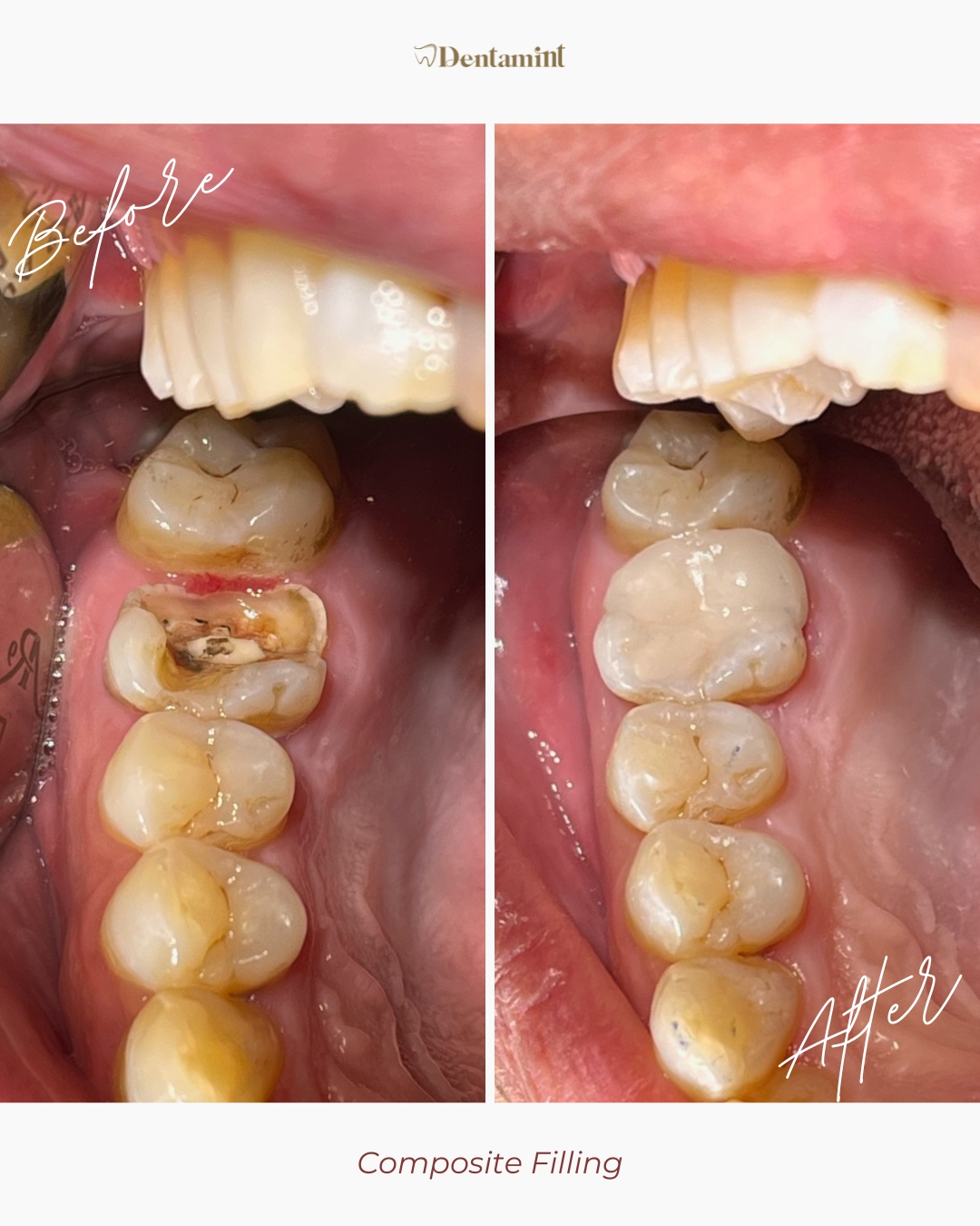 Tampalan Gigi - Klinik Pergigian Dentamint