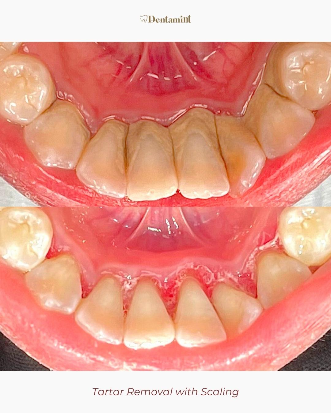 Scaling Gigi - Klinik Pergigian Dentamint