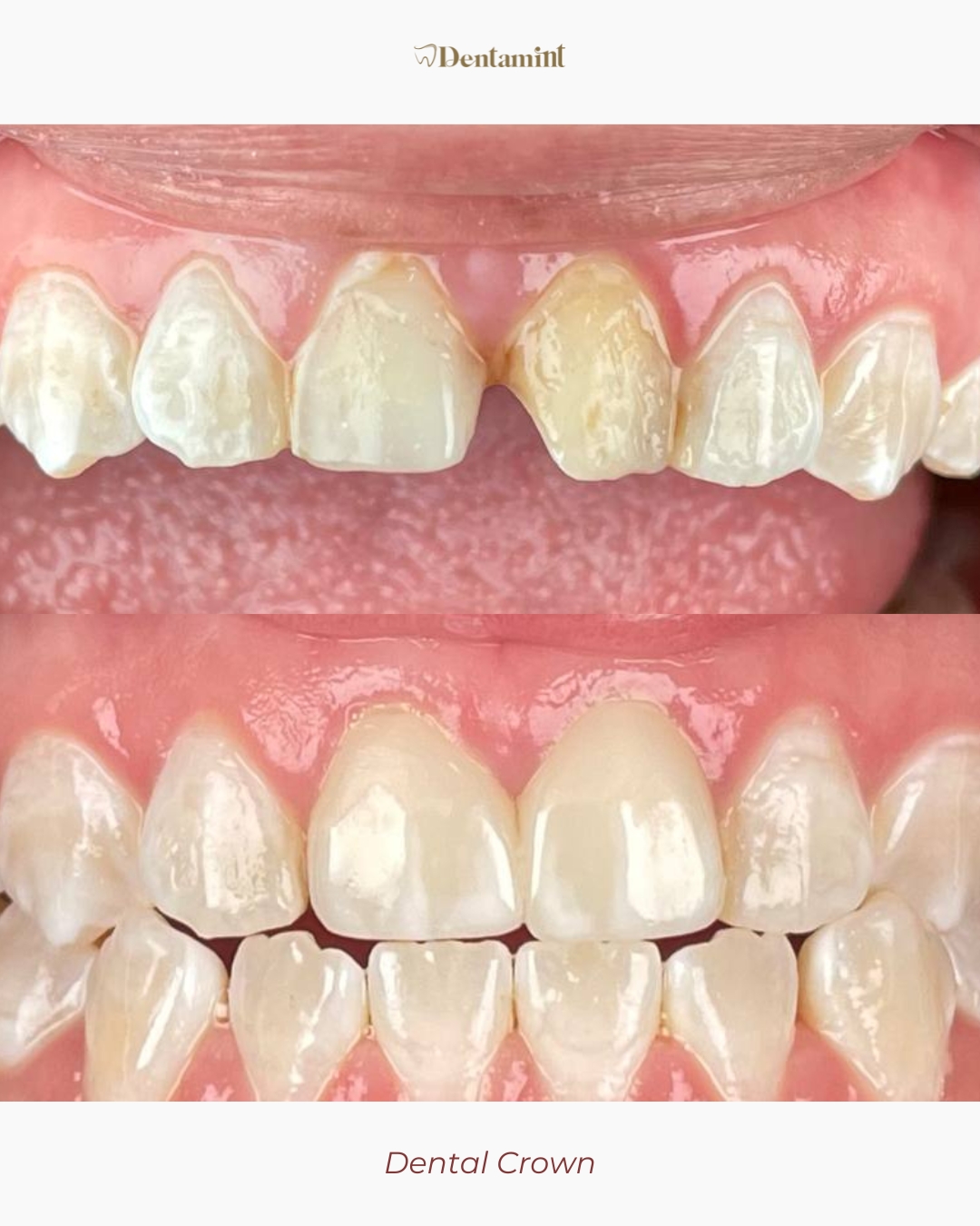 Crown Gigi - Klinik Pergigian Dentamint