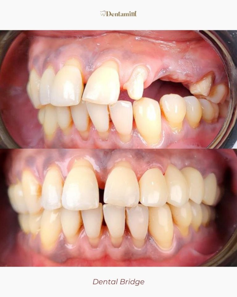 Bridge Gigi - Klinik Pergigian Dentamint