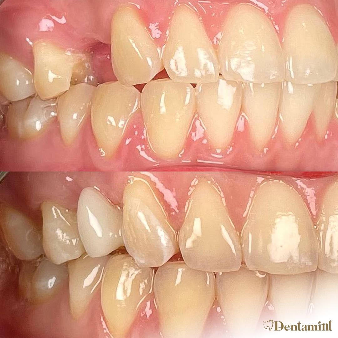 Bridge Gigi - Klinik Pergigian Dentamint