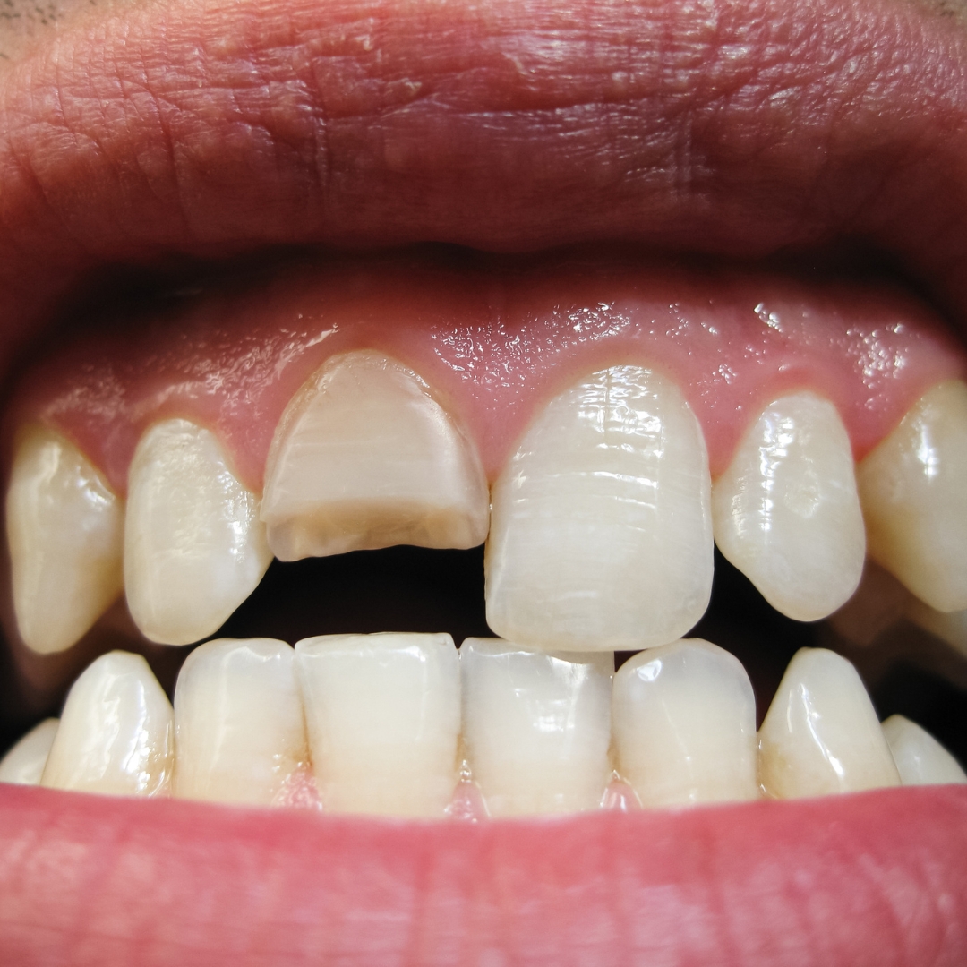 Veneer - Klinik Pergigian Dentamint